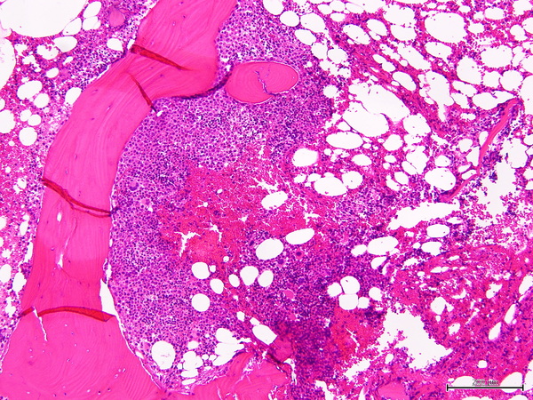 Chloroma : 滋賀医科大学 第二病理 写真館