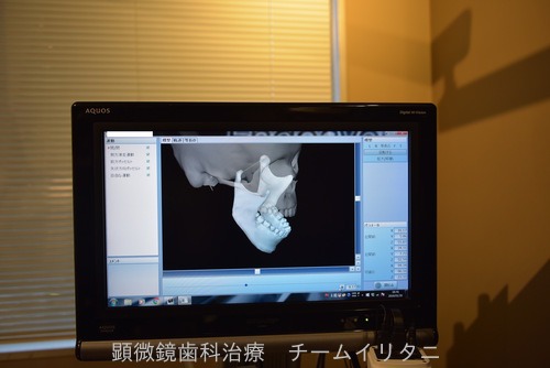 咬合、咬み合わせの観察 東京職人歯医者 KAVOプロターevo7 Arcus Digma : 【イリタニオフィス】東京職人歯医者の神経を、歯を ...