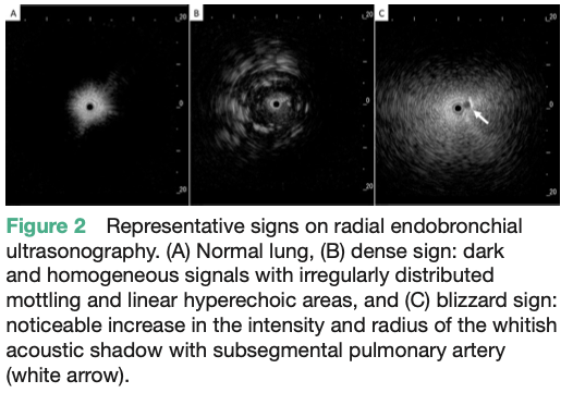 びまん性肺疾患に対するTBLC時に併用するR-EBUSでdense signが見られると質の高い検体採取が可能であり出血合併症も少ない ...