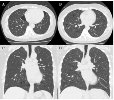 BHD症候群とLAMにおける嚢胞の比較 : ILD Reports