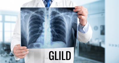 分類不能型免疫不全症 (CVID)におけるGLILD合併の予測因子 : ILD Reports