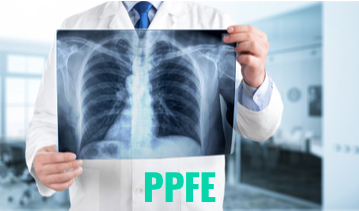 PPFEにおける肺高血圧 : ILD Reports